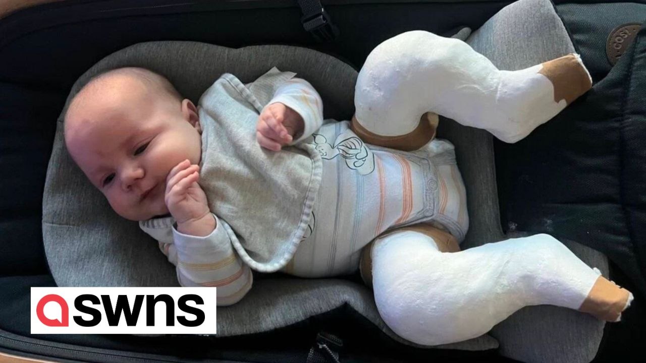 Baby has spent half of his life in leg casts after he was born with his ...