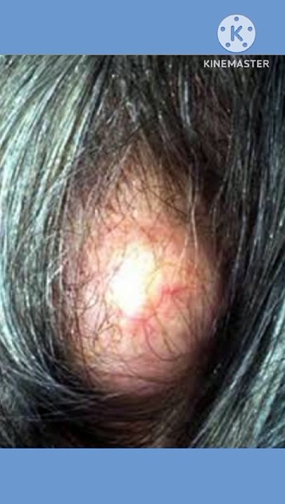 cyst/pilar cyst/ cyst in head/pilar cyst /pilar cyst treatments/ pilar ...