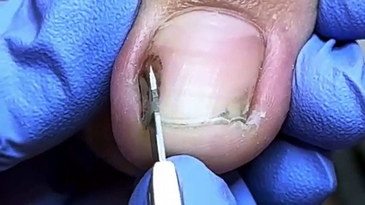 Wow~ Broken toenail with clotted blood hidden underneath【Doctor Liu ...