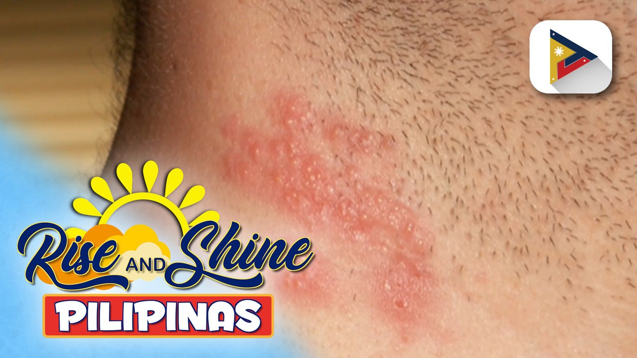 SAY ni DOK | Alamin ang mga karaniwang sakit sa balat na nauuso tuwing ...