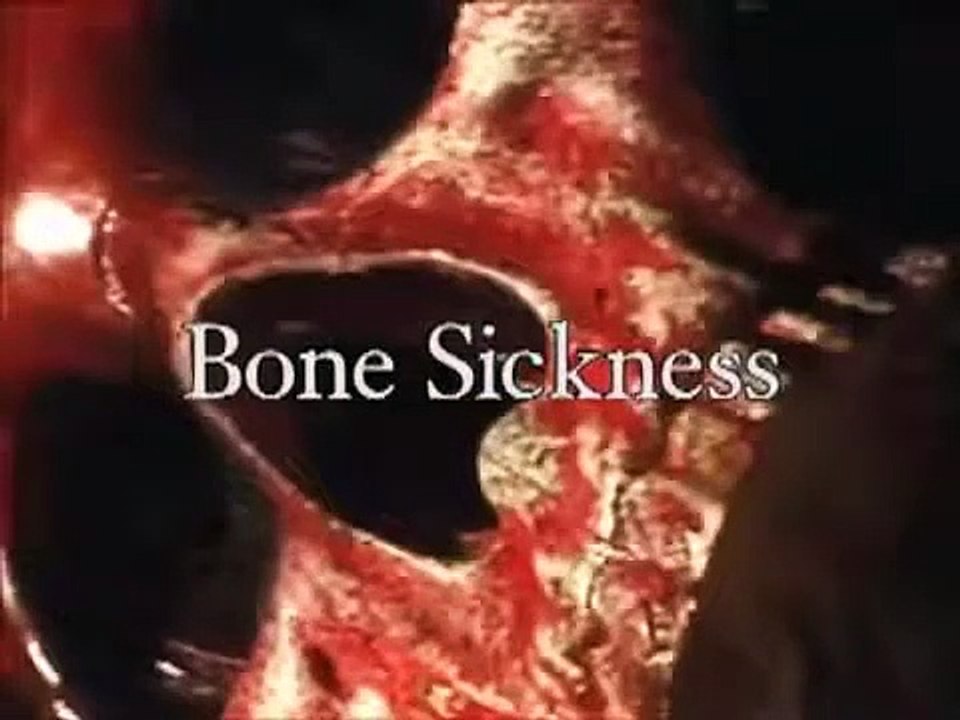 Bone Sickness Bande-annonce (EN) - Vidéo Dailymotion