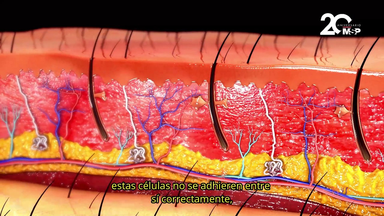 Dermatitis atópica y un viaje al interior de la piel inflamada - # ...