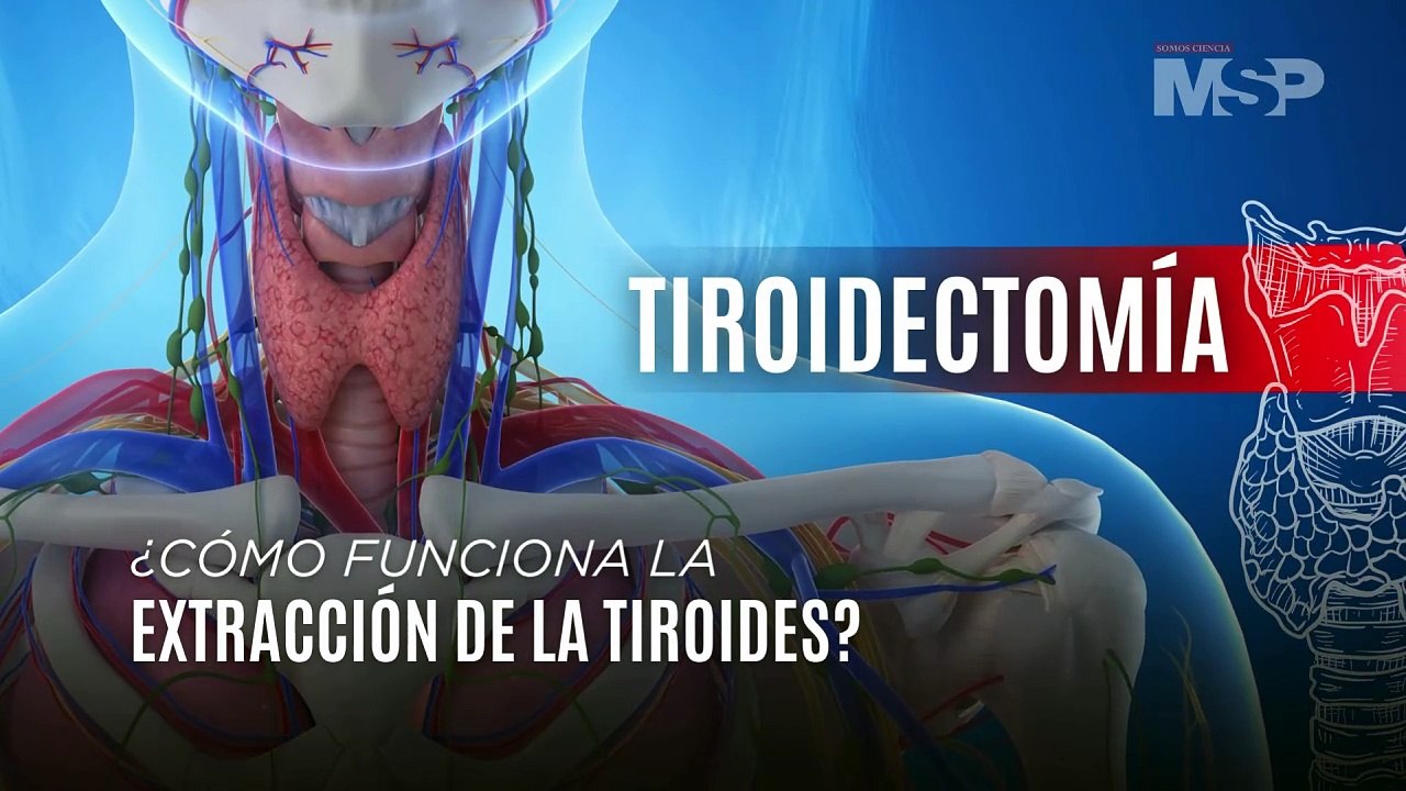 Tiroidectomía: ¿Cómo funciona la extracción de la tiroides? - # ...