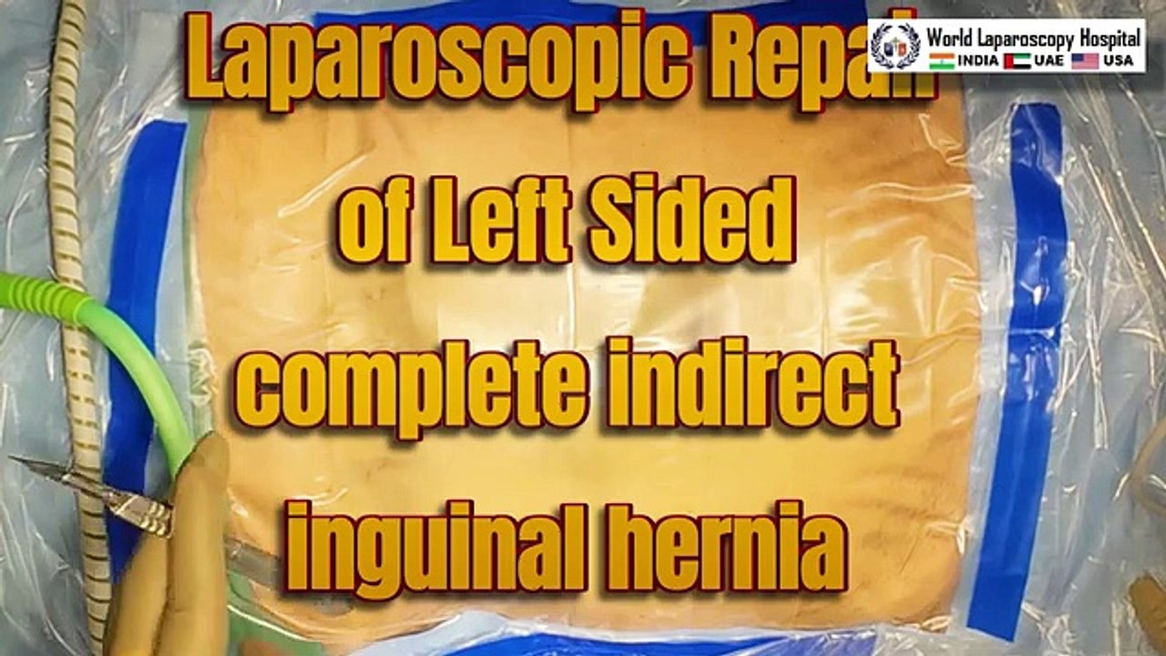 Laparoscopic Repair of Left-Sided Complete Indirect Inguinal Hernia ...