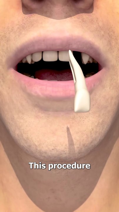 Tooth In Eye Surgery (explained) - video Dailymotion