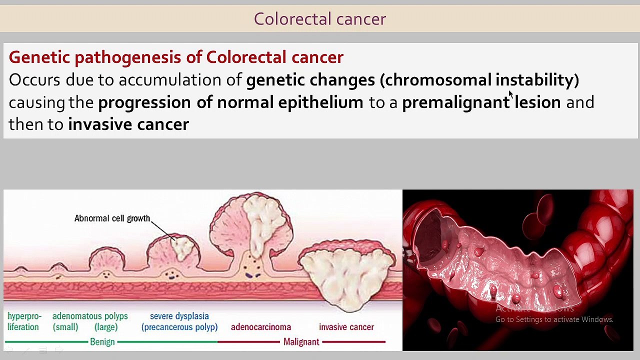 9.Abdomen_GIT cancer_ colorectal cancer - video Dailymotion