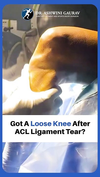 Fix Loose Knee Ligaments With ACL Ligament Surgery in Patna, Bihar - Dr ...