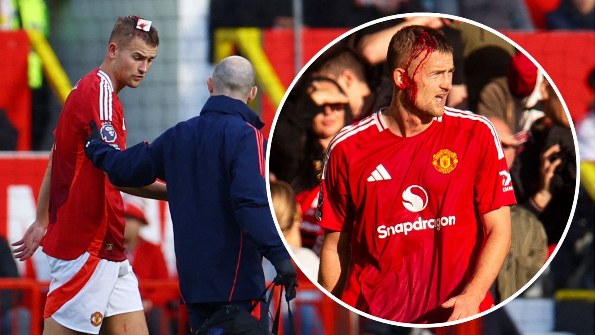 (PHOTOS) Matthijs De Ligt's Bloody Injury | beIN SPORTS