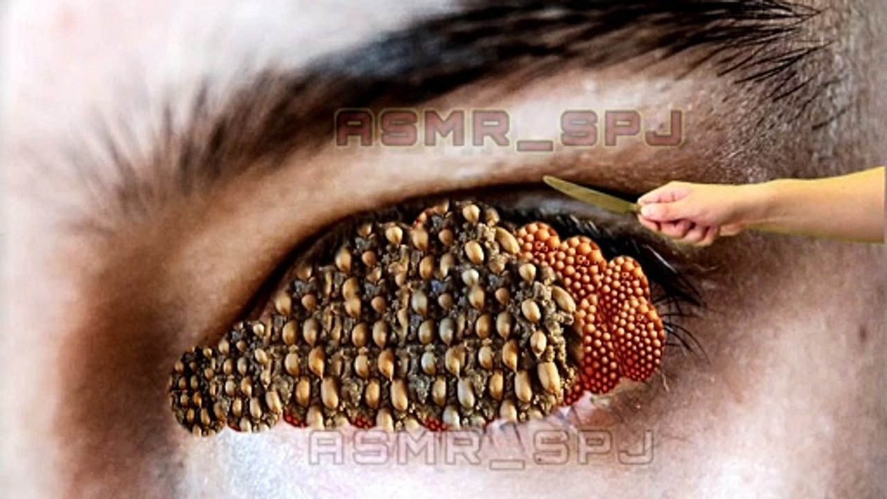 Relaxing ASMR Maggot and Tick Removal Eye Animation | Satisfying Asmr ...