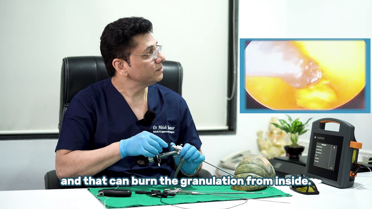 Video Assisted Anal Fistula Treatment (VAAFT)_ Step-by-Step Guide ...