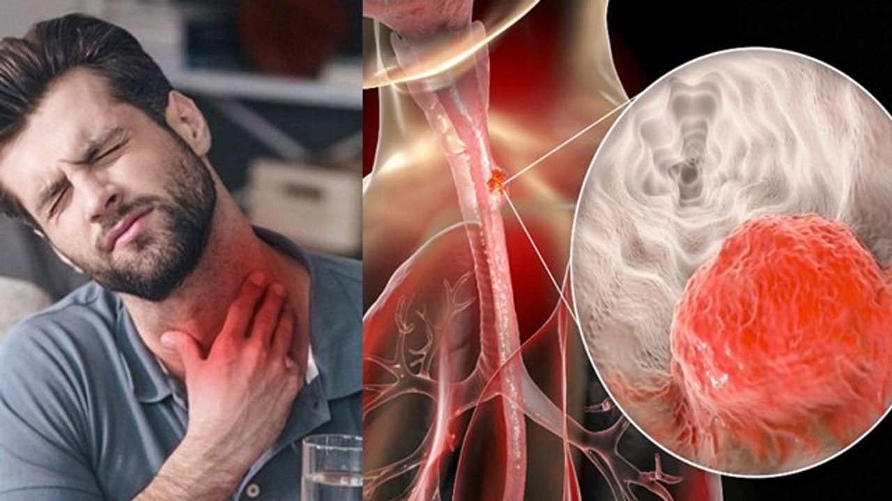 Esophageal Cancer Treatment: Food Pipe Cancer Treatment In Hindi ...