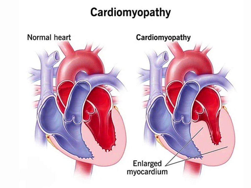 cardiomyopathy || 5 diseases of the heart muscle that can cause death ...