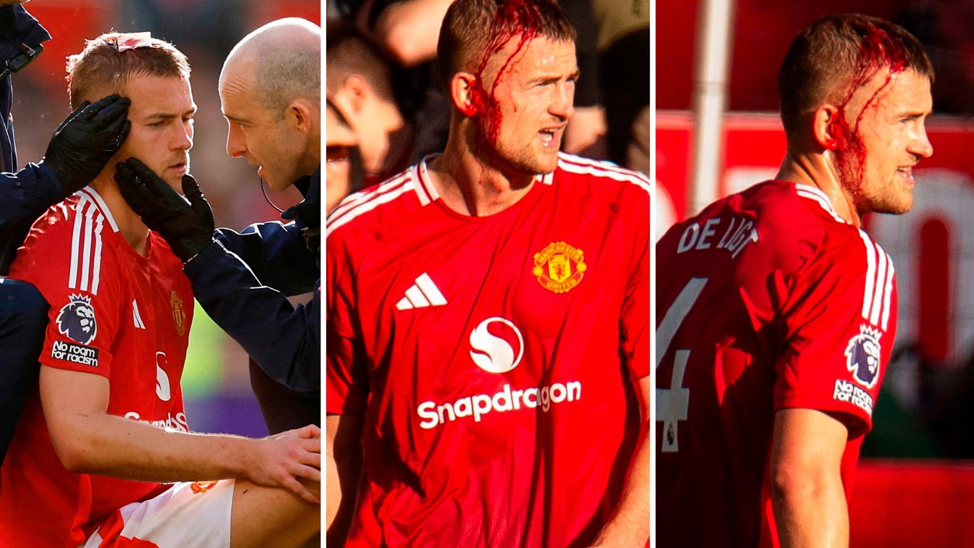 Manchester United: Why Was Matthijs De Ligt’s Face Covered in Blood ...