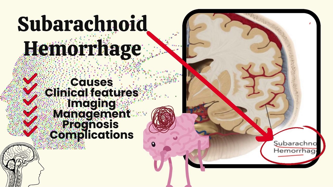 Subarachnoid Hemorrhage | Types, Cause, Clinical Features, CT Scan ...