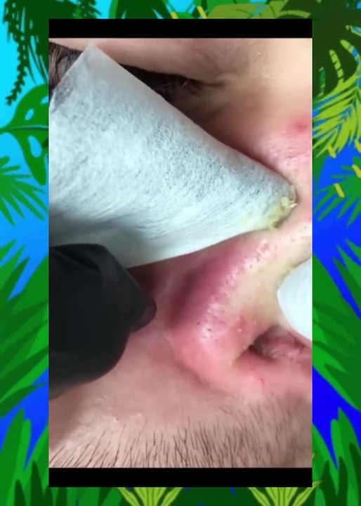 Gentle Nose Blackhead Extraction & Soothing ASMR | Skin Therapy ...