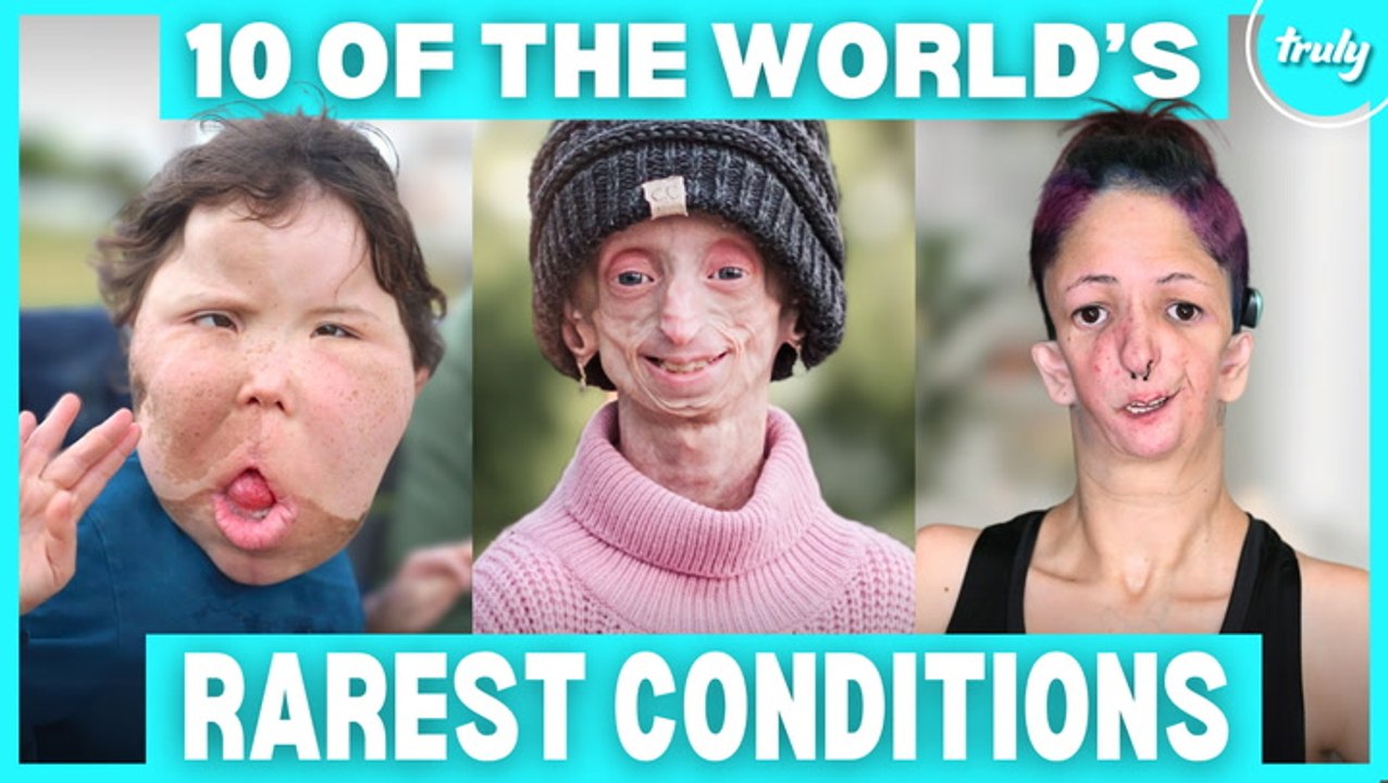 10 Incredible People Who Defied The Rarest Conditions | BORN DIFFERENT ...