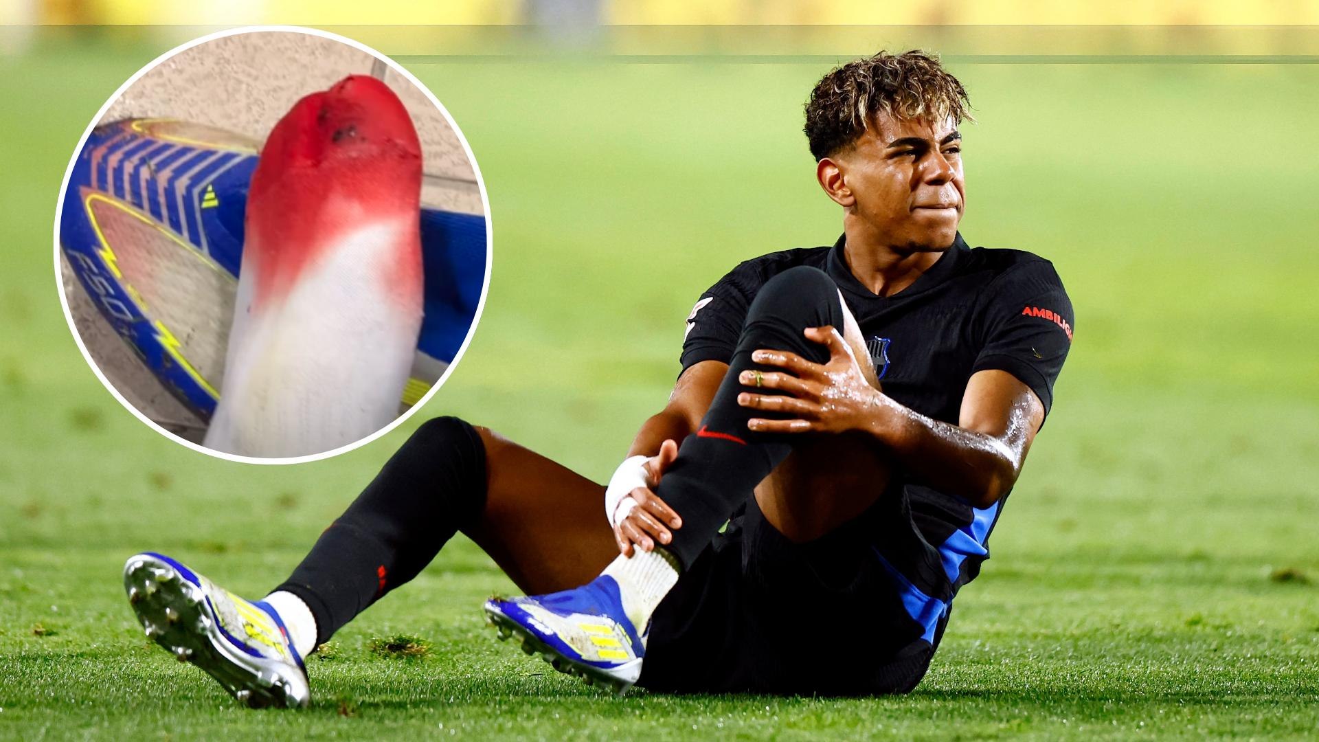 (VIDEO) This Is How Lamine Yamal’s Foot Looked After the Stomp | beIN ...
