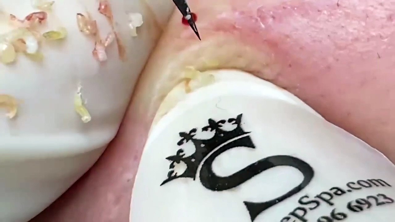 Blackhead Removal ASMR - Doctor Pimple Popper Inspired - video Dailymotion