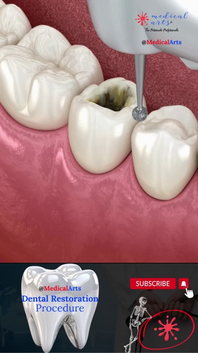 Dental Restoration ↪ Composite Bonding Teeth ↪ 3D Medical Animation ...